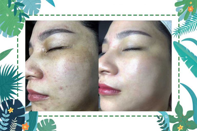 Phi kim làm đẹp có tốt không? Hướng dẫn chăm sóc da tại nhà sau phi kim